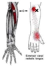 Trigger Points and Elbow Pain — Lanier Therapy in Motion