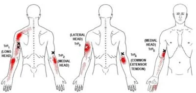 Trigger Points and Elbow Pain — Lanier Therapy in Motion