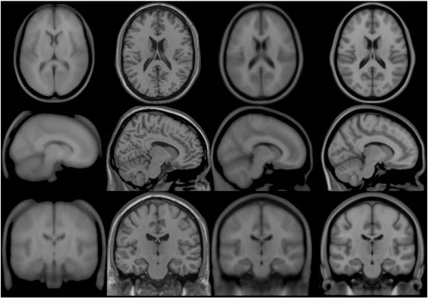 Brief History of the MNI Template — Andy's Brain Blog