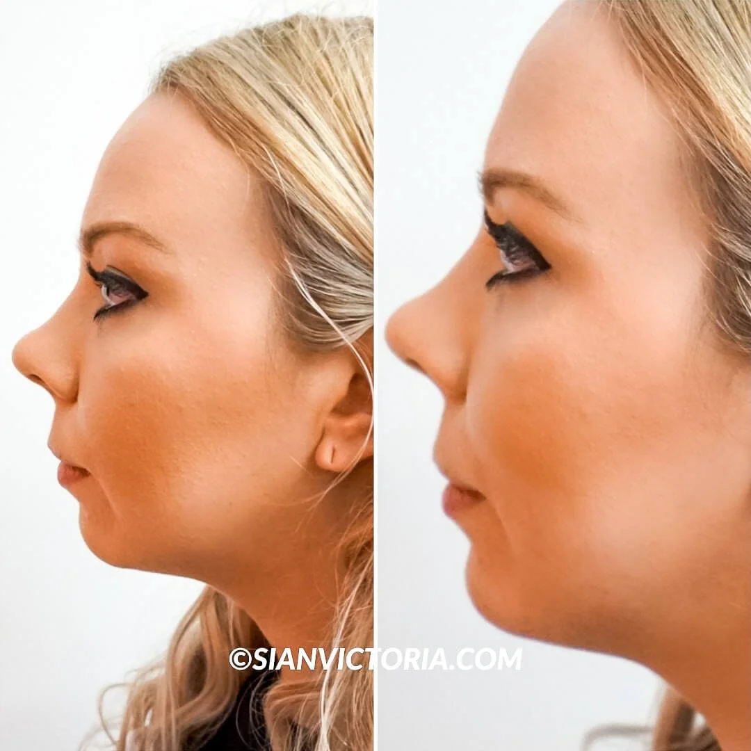 Before & After - Chin filler treatment in Birmingham — Sian Victoria.