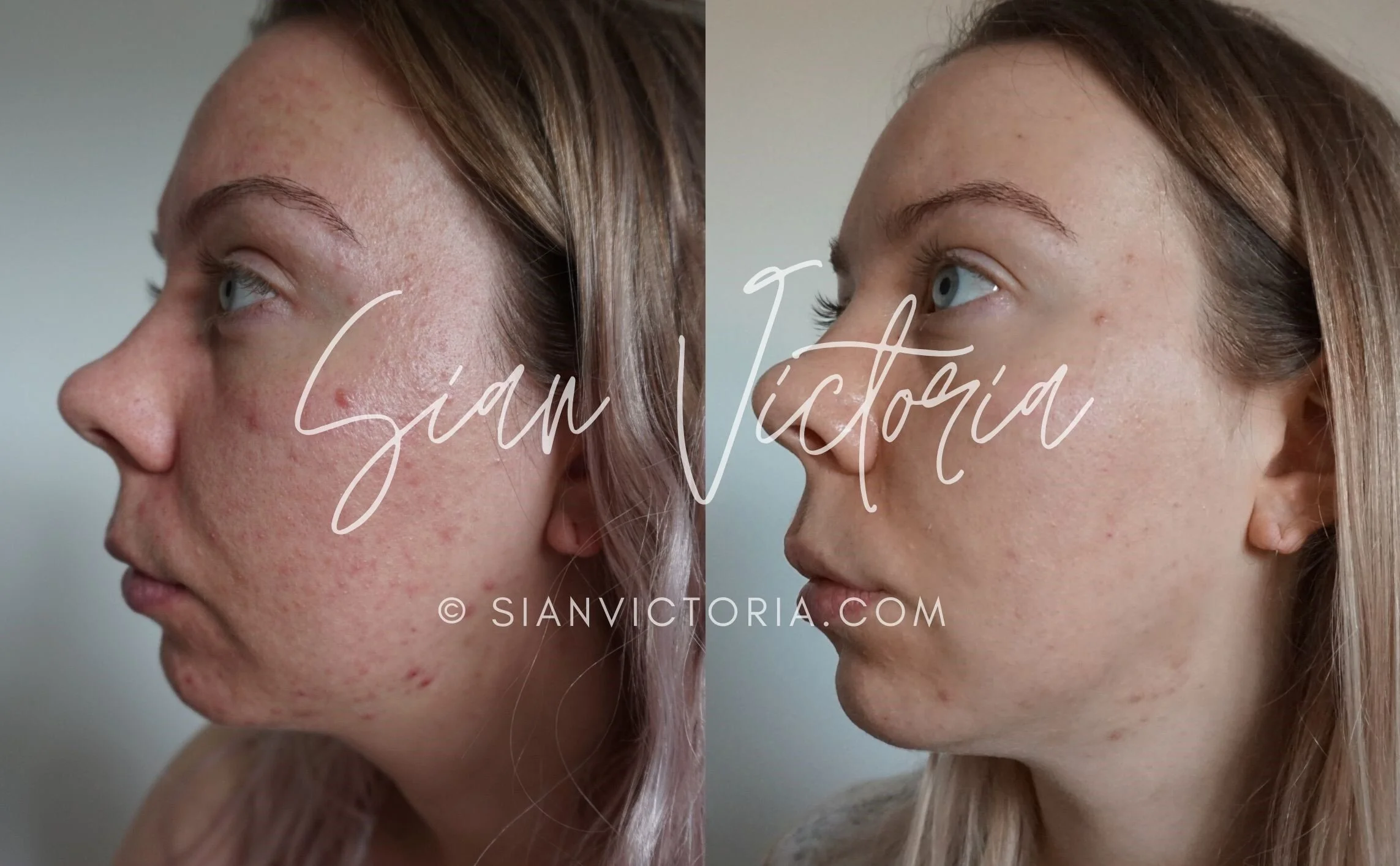 Before & After Skin Results #100DayReset Challenge — Sian Victoria.