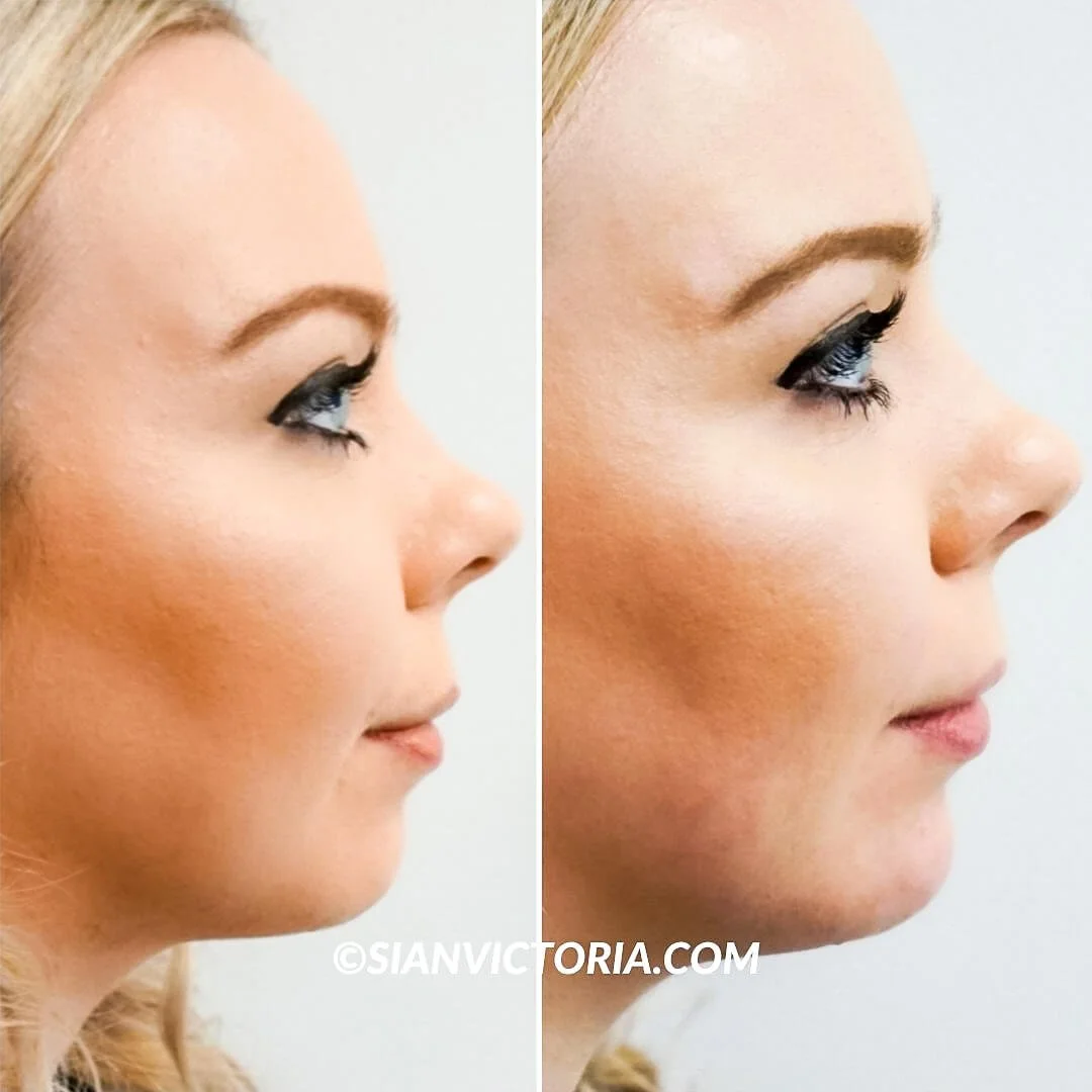 Before & After - Chin filler treatment in Birmingham — Sian Victoria.