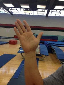 TFCC Injury: the "meniscus tear" of the wrist — ACRO: Physical Therapy ...