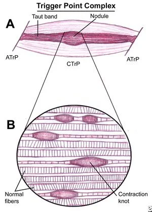 Trigger Point Dry Needling (TDN) — ACRO: Physical Therapy, Massage ...