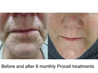 Skincare Skin Care Intraceuticals Oxygen Facial Dermaplaning Kerstin ...