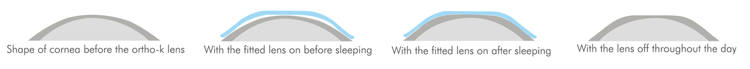 Oprthokeratology Ortho K — Eyetek Optometrists