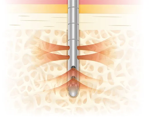 Cell-HarvestOR — Matrix Biosurgical