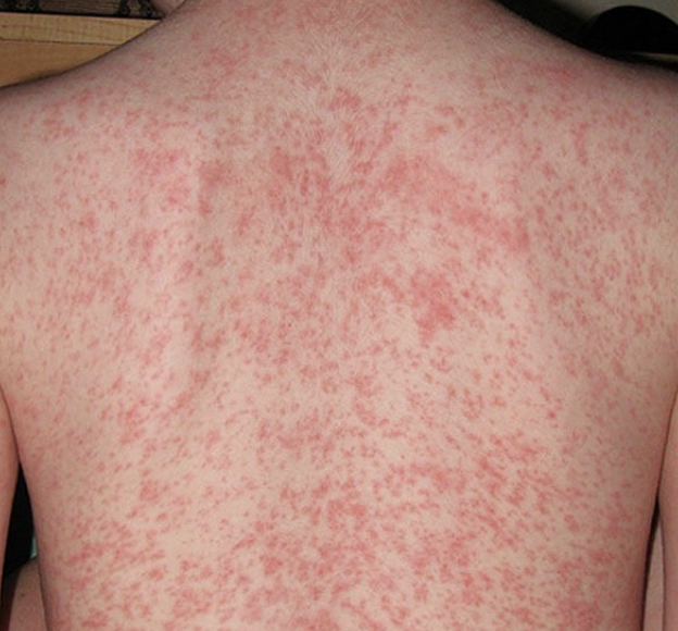 Heat Rash On Back