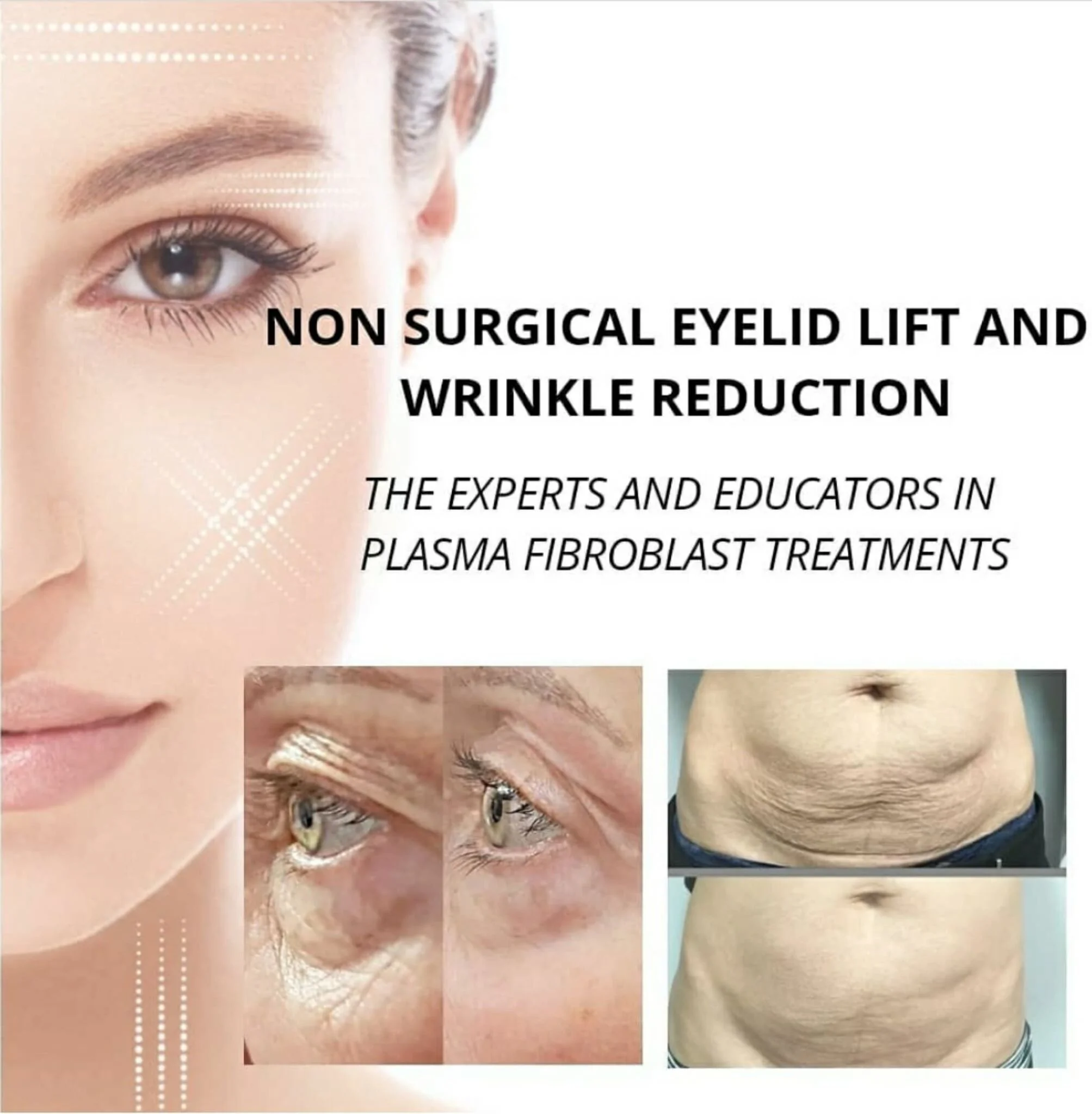 PLASMA FIBROBLAST — Skin Architecture