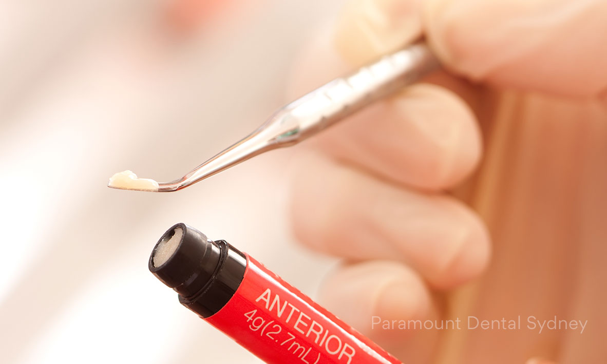 Composite Veneers - Dental Bonding | Paramount Dental Sydney ...