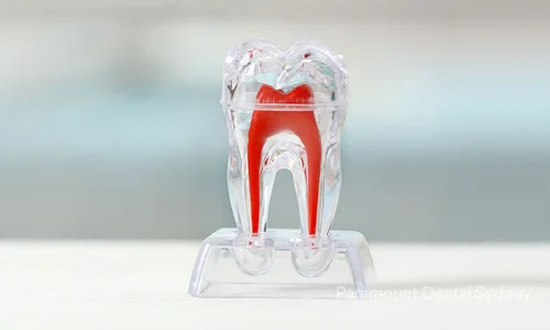 Pulp Extirpation - Save Your Teeth | Proven Track Record — Paramount ...