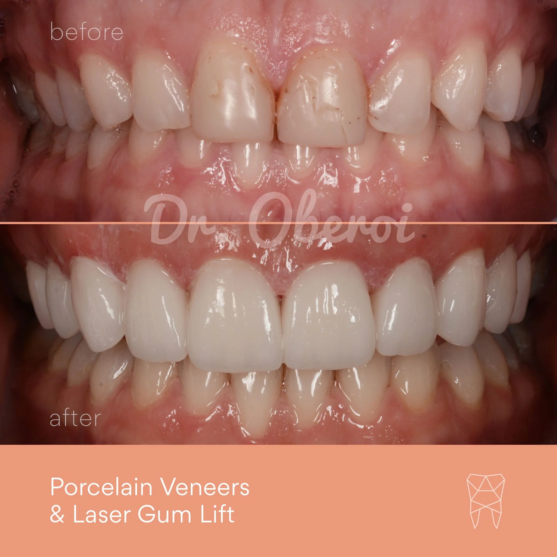 Porcelain Veneers Sydney CBD | Create A Beautiful Smile — Paramount Dental Sydney