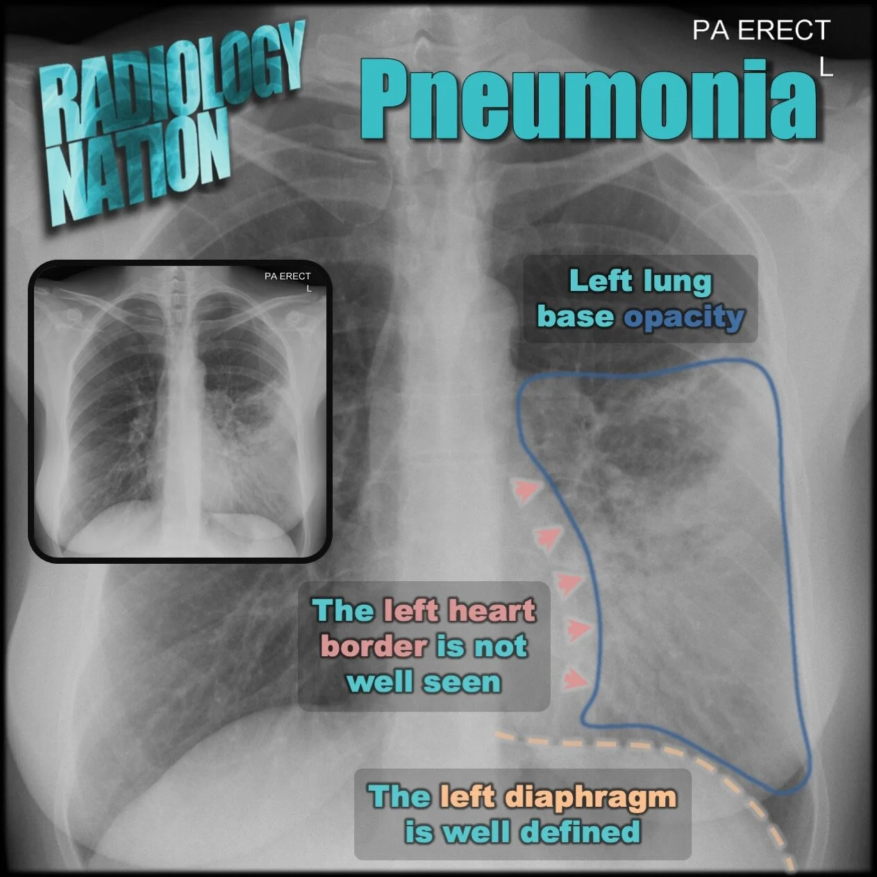 Chest Radiographs — Radiology Nation