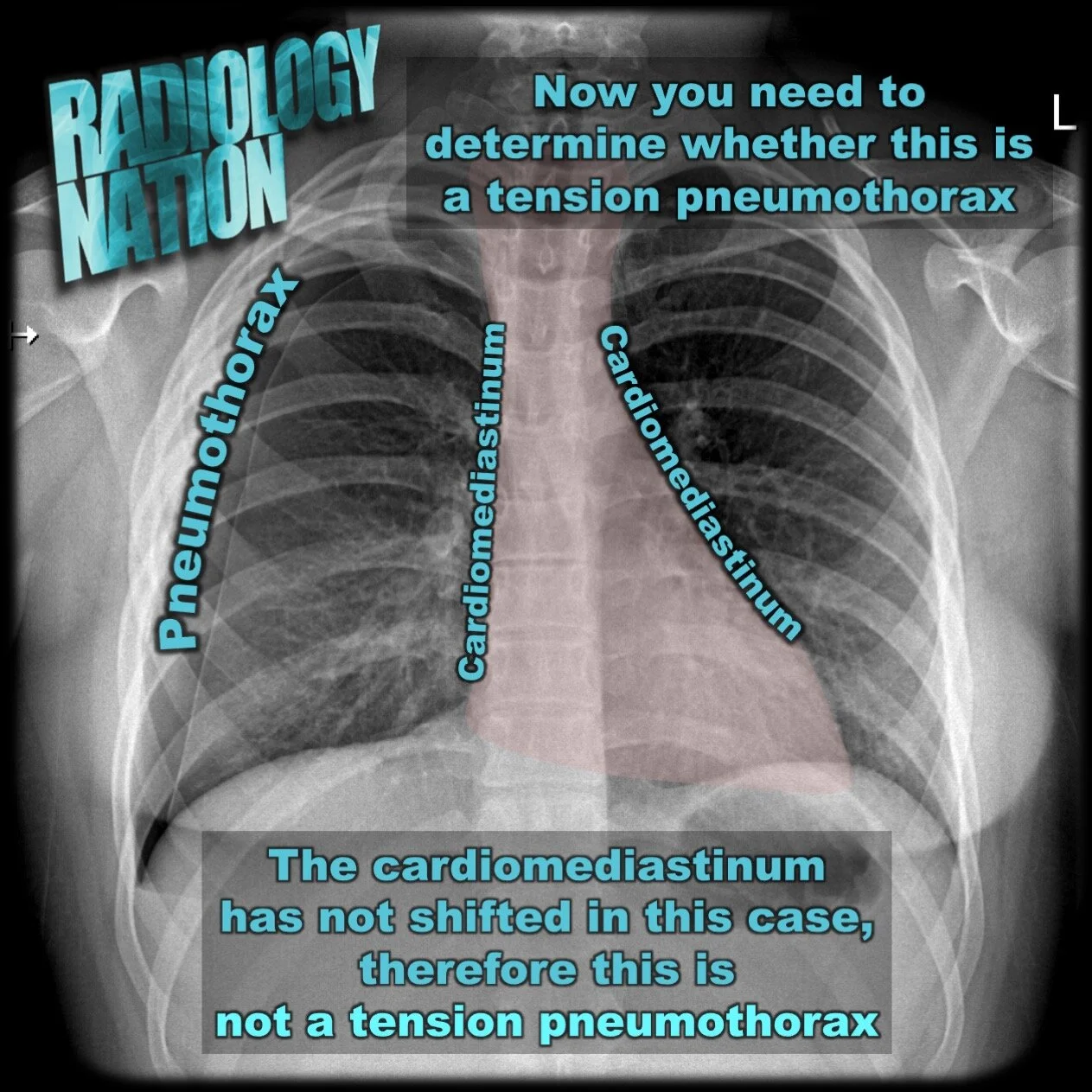 Chest Radiographs — Radiology Nation