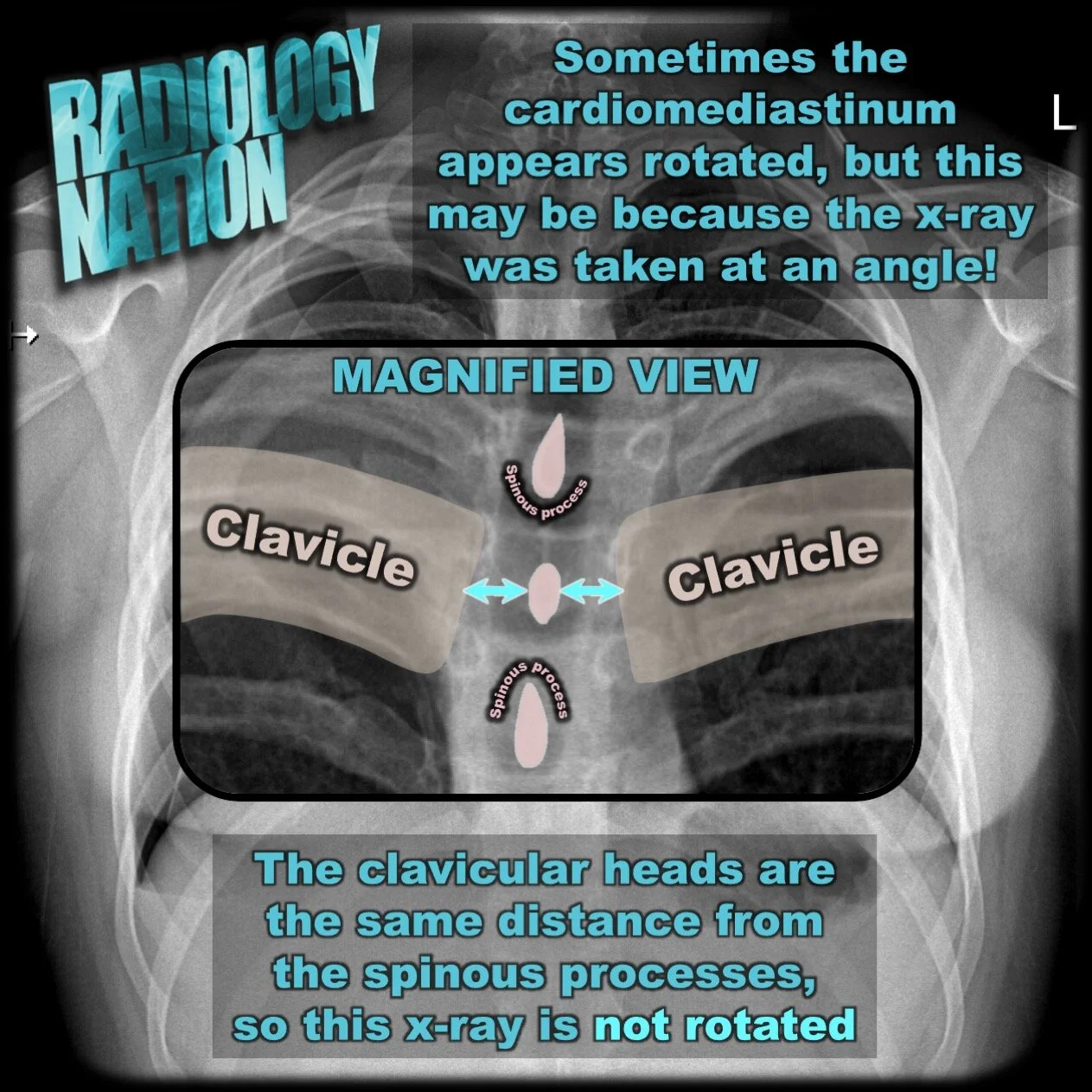 Chest Radiographs — Radiology Nation
