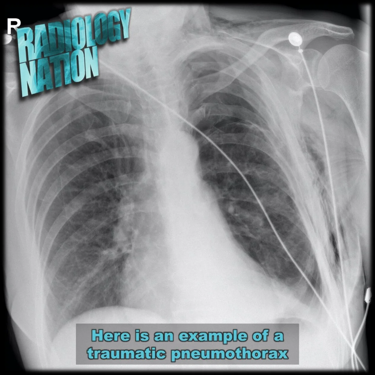 Chest Radiographs — Radiology Nation