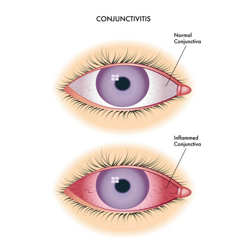 Conjunctivitis — Salle Opticians