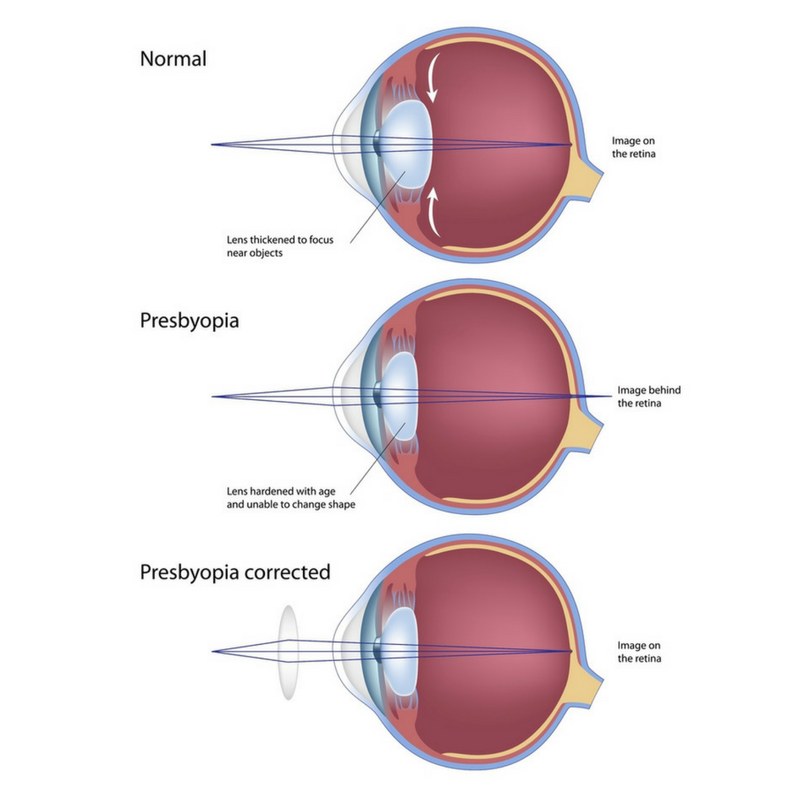 Presbyopia — Salle Opticians