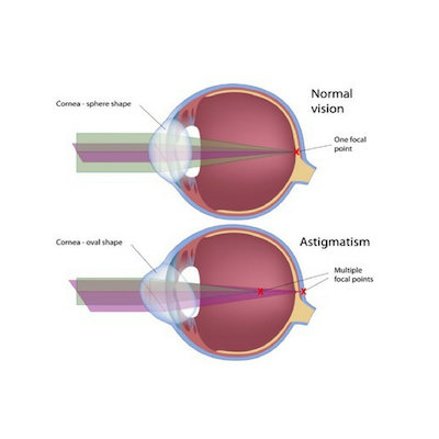 Astigmatism — Salle Opticians