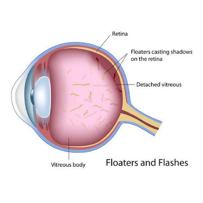 Floaters & Spots — Salle Opticians