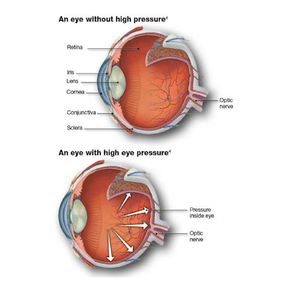 Ocular Hypertension — Salle Opticians