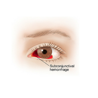 Subconjunctival Hemorrhage — Salle Opticians