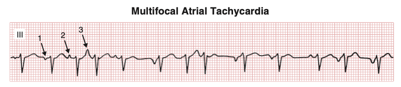 Supraventricular Tachycardias - The Narrow Waves of Chaos — Firstclass