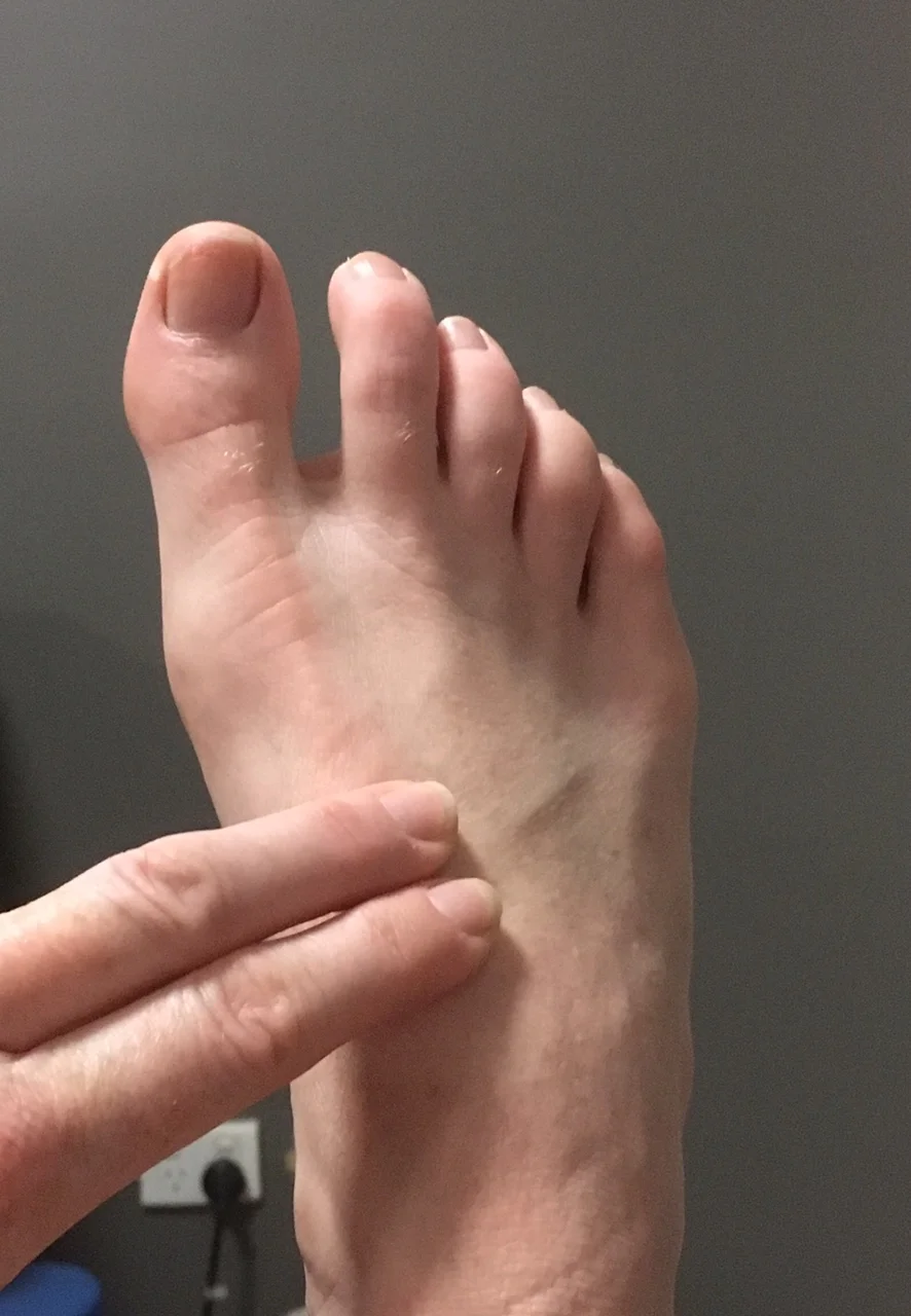 Diabetes and Feet — Better Steps Family and Sports Podiatry