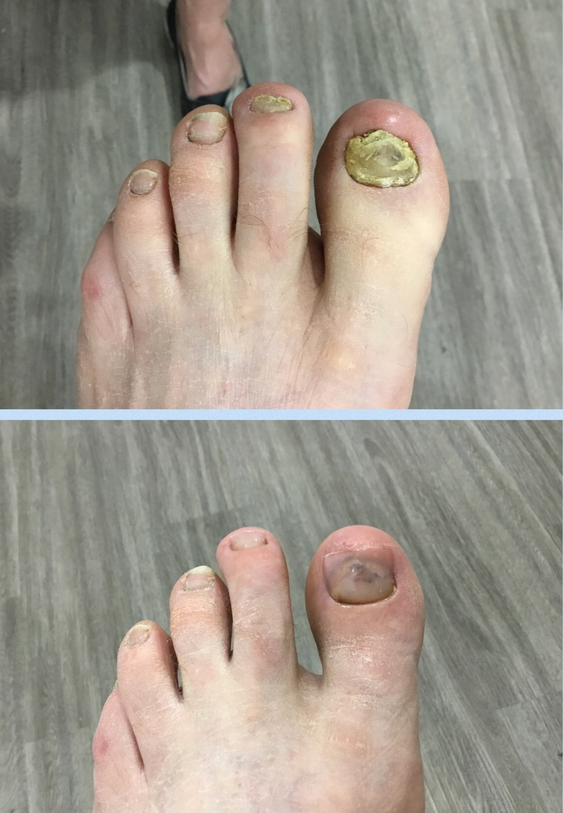 Keryflex Nails — Better Steps Family and Sports Podiatry