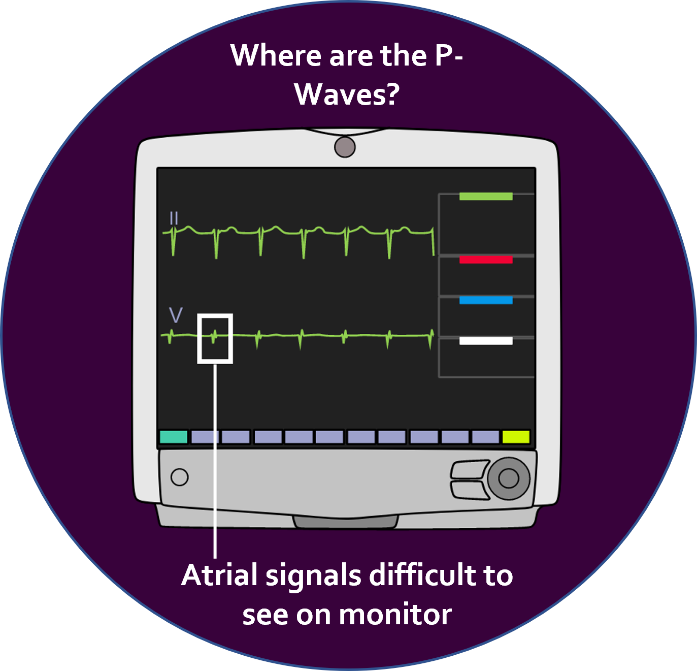 Atrility Medical - Improving access to the atrial electrogram