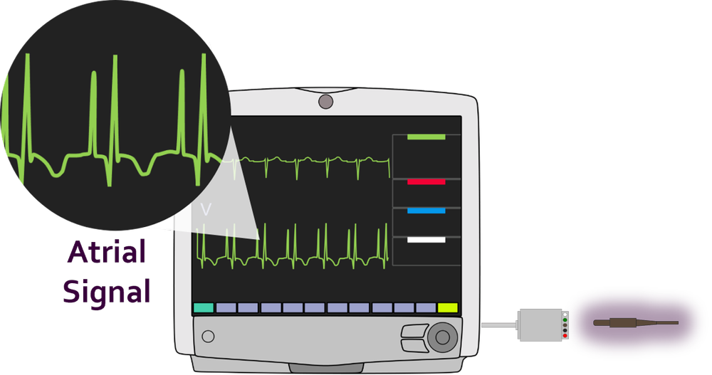 Atrility Medical - Improving access to the atrial electrogram