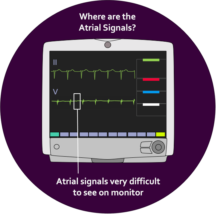 Atrility Medical - Improving access to the atrial electrogram