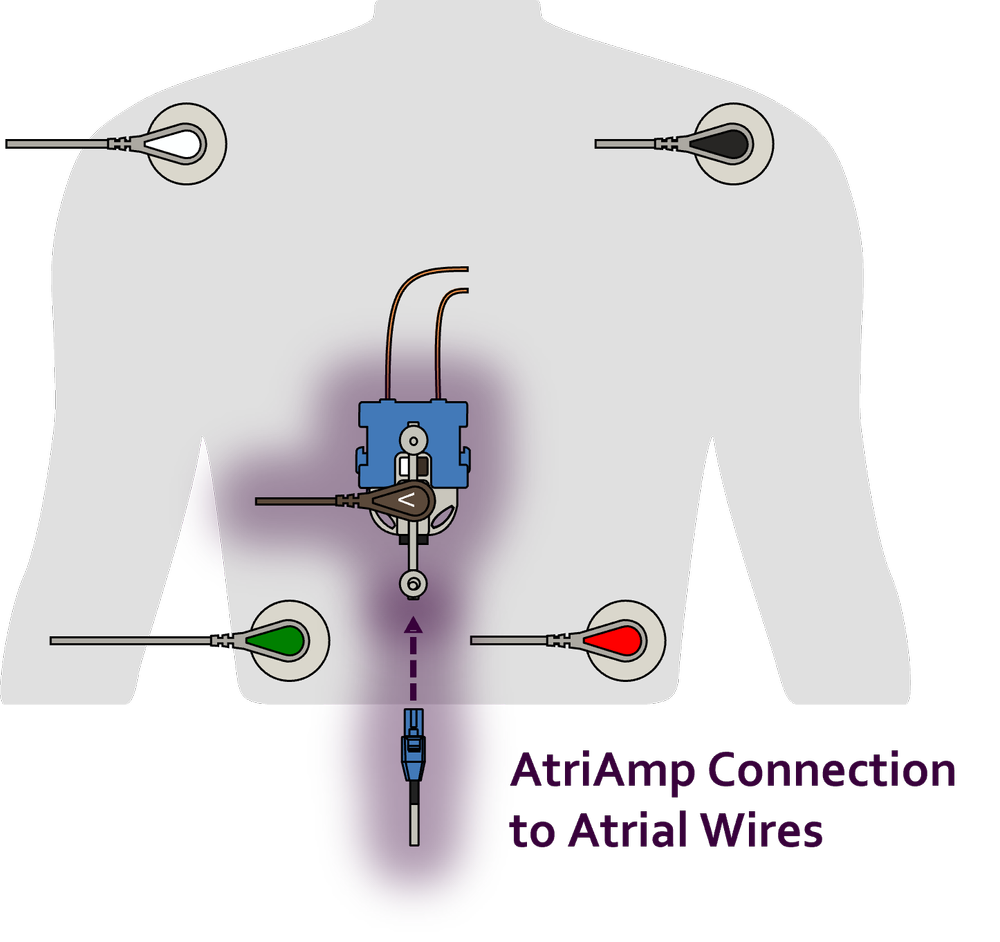 Atrility Medical - Improving access to the atrial electrogram