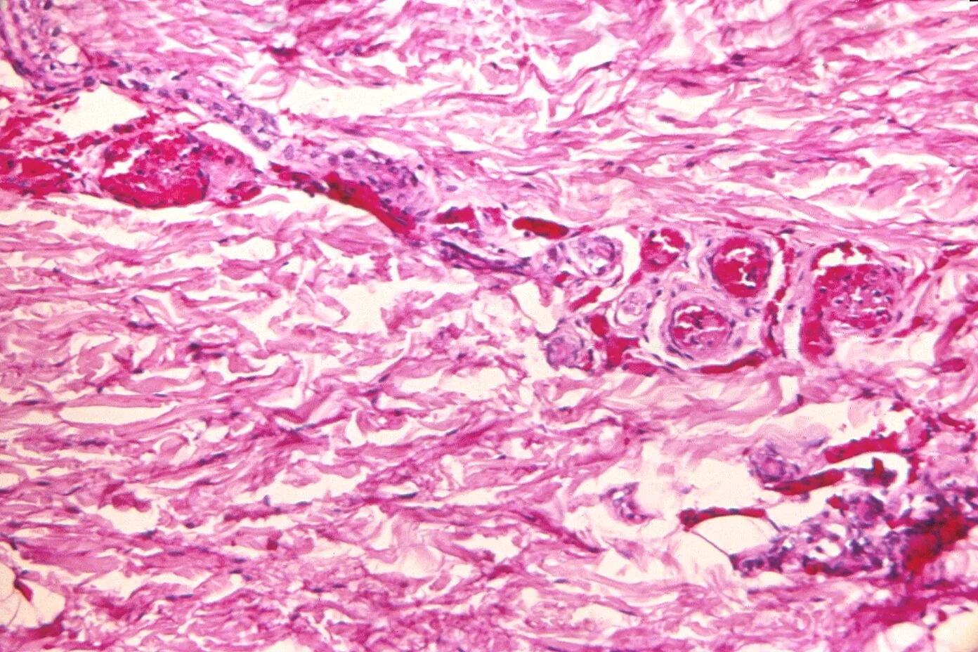 Petechial Hemorrhages — Medilex: The Experts on Medical Experts