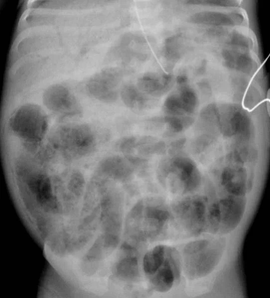 Necrotizing Enterocolitis (NEC) — Medilex: The Experts on Medical Experts