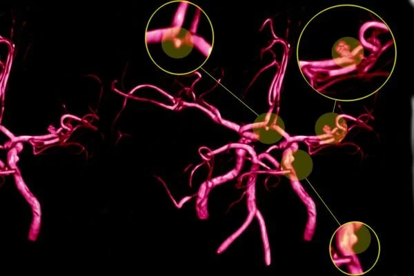 Brain Aneurysms and Strenuous Activity — Medilex: The Experts on ...