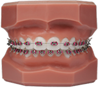 Anchorage Orthodontic Treatment — Murray Orthodontics