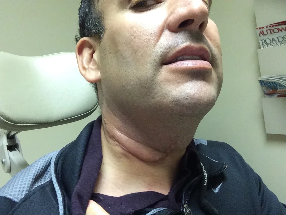 Radical Neck Dissection Post Op