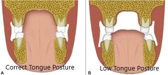 Tongue Posture/Tongue Thrust — Face Forward