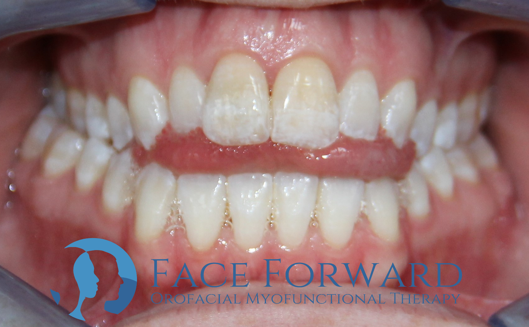 Tongue Posture/Tongue Thrust — Face Forward