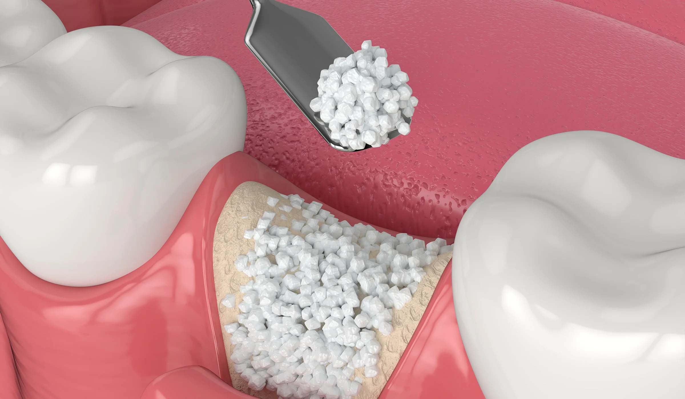 HIMED — Hydroxyapatite (HA) for Bone Regeneration in Orthopedic and ...