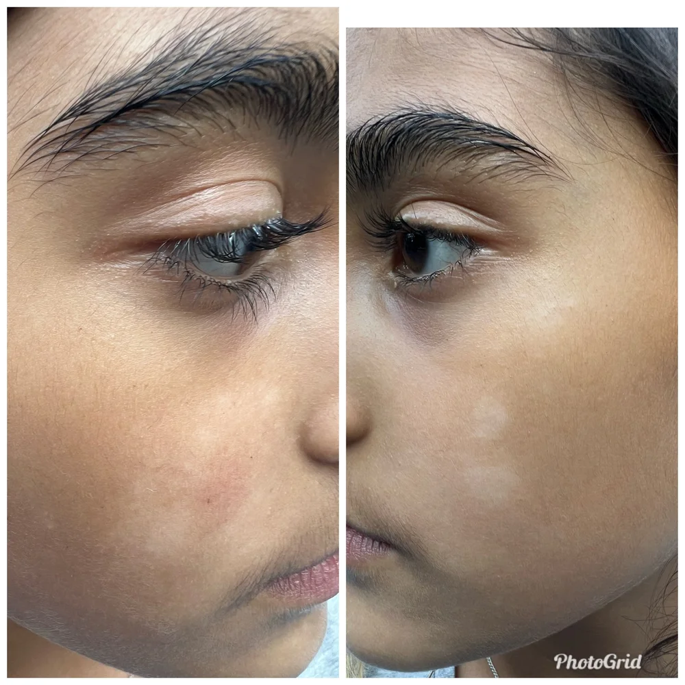 White Patches on the skin? Treating Tinea Versicolor naturally. — NŪR ...