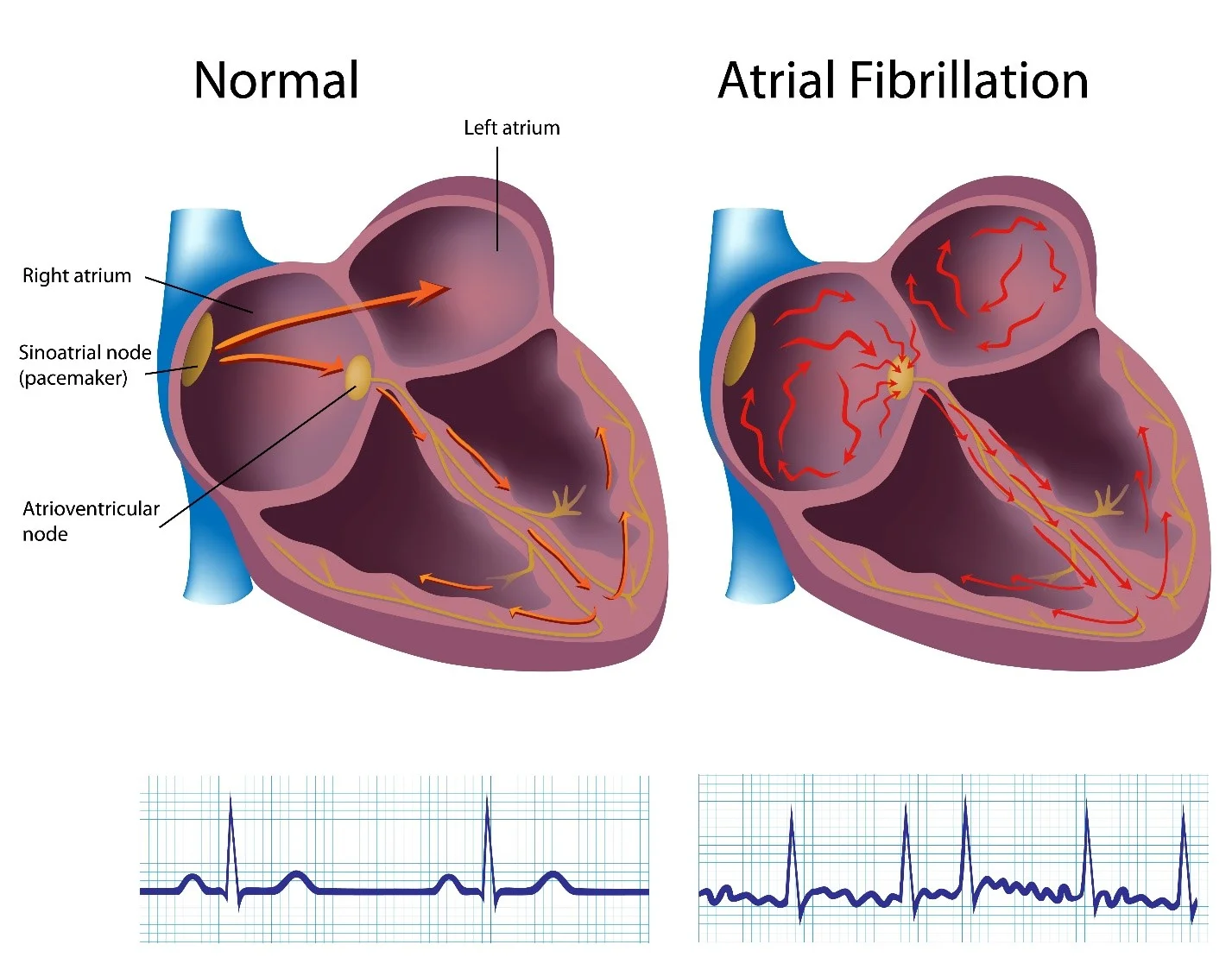 Atrial Fibrillation 心房顫動 — AAMG Doctors