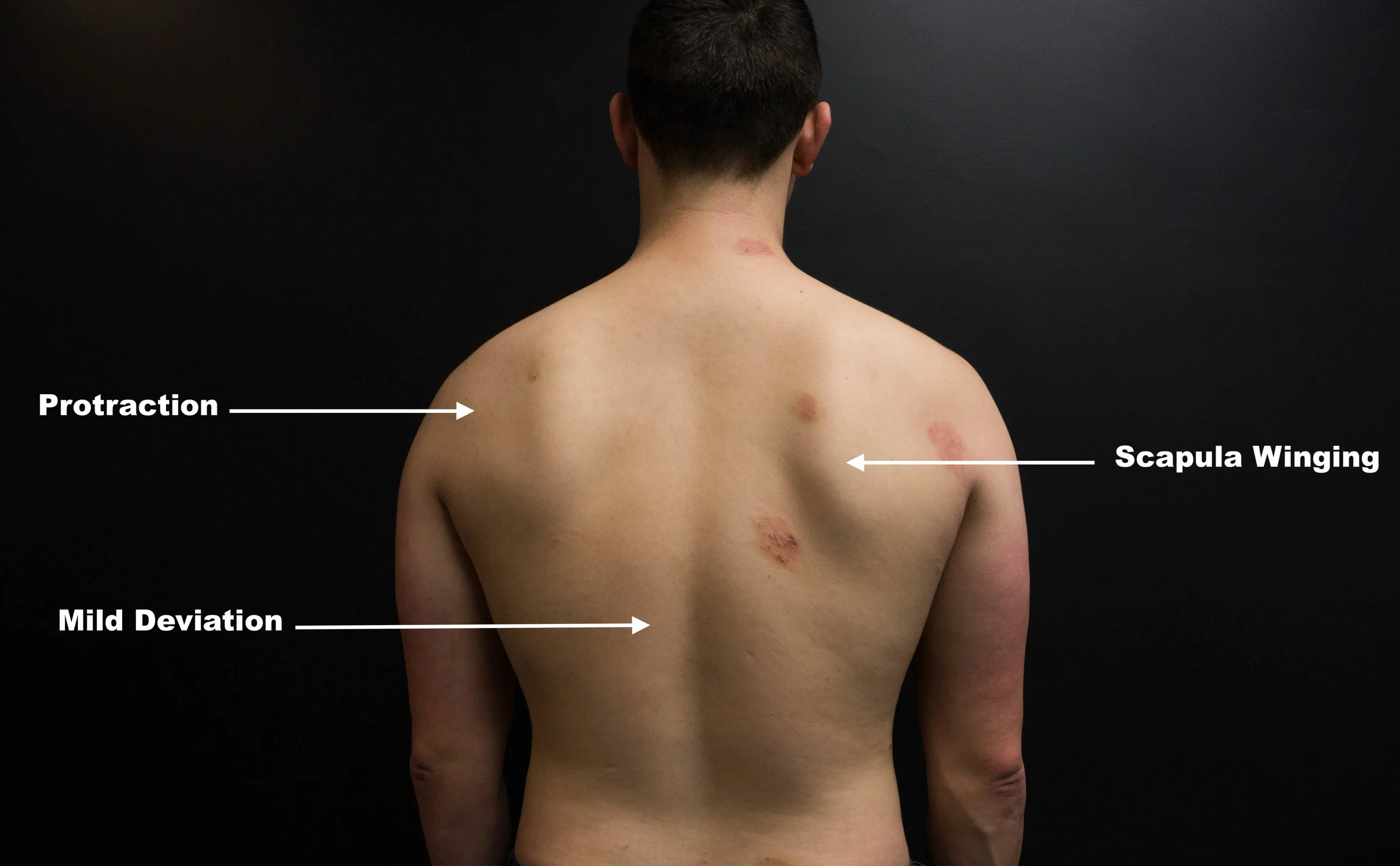 Winged Scapula And Shoulder Pain Case Study ONI Wellington