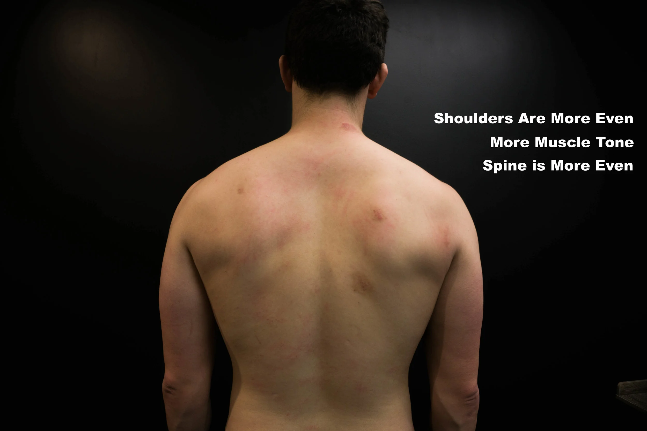 Winged Scapula And Shoulder Pain Case Study ONI Wellington