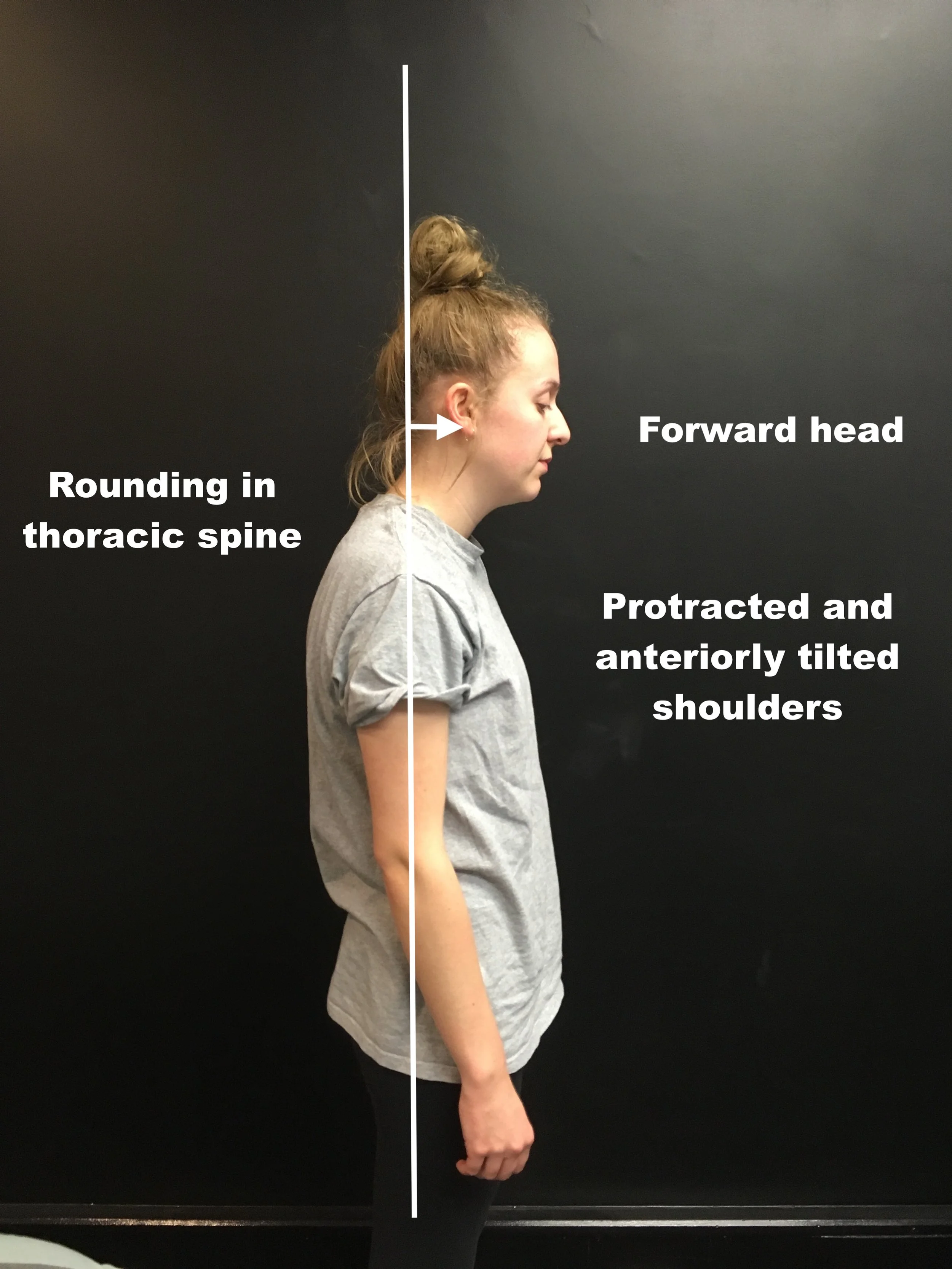 Upper Crossed Syndrome [CASE STUDY] — ONI | Wellington Personal ...