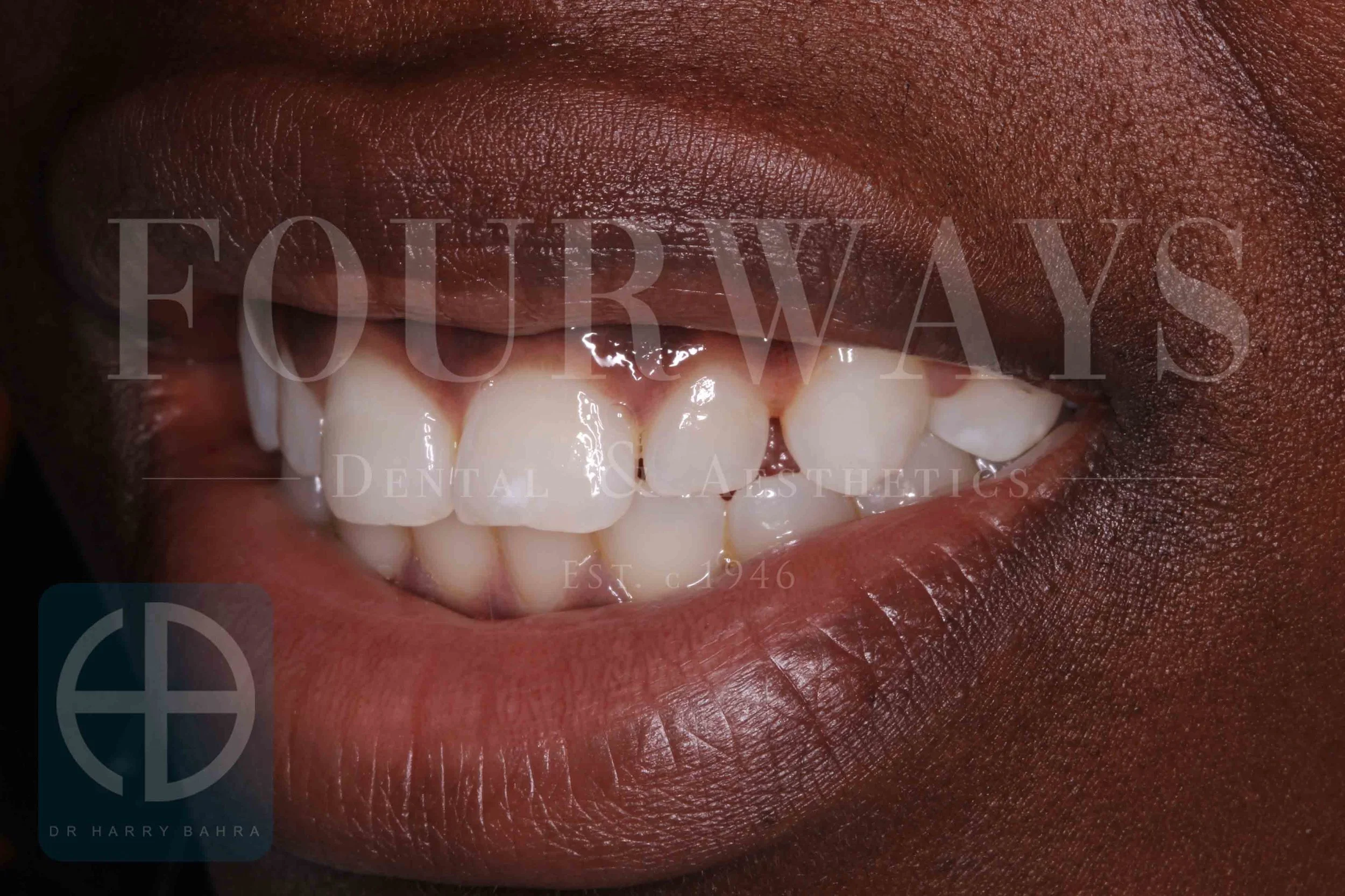 Composite Bonding Gaps & Diastemas - Gallery — Fourways Dental Clinic