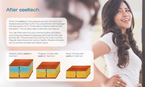 Fat Freezing Perth | Cool Tech Fat Freeze Perth — Body Wisdom Perth