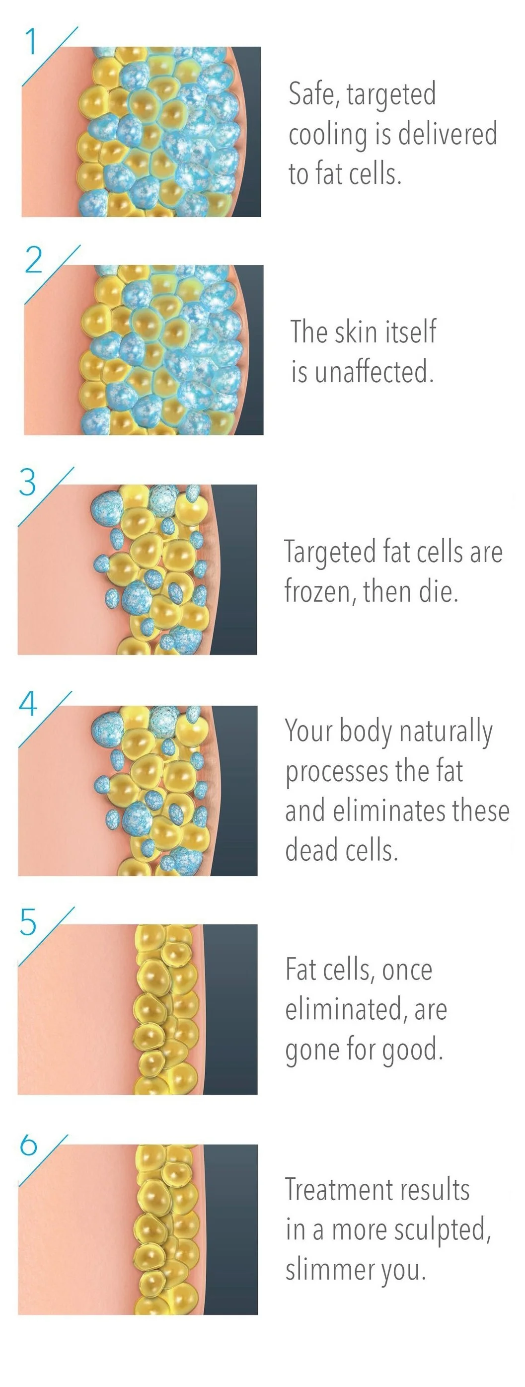 Fat Freezing Perth | Cool Tech Fat Freeze Perth — Body Wisdom Perth