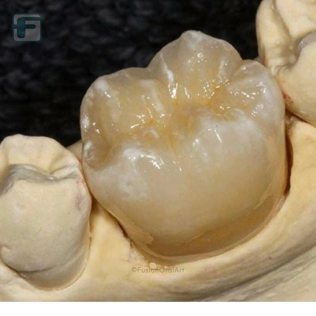 Crowns, Veneers, Inlays & Onlays — Fusion Oral Art